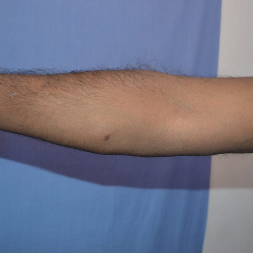 Multiple Lipoma Removal with Minimally Invasive Surgery | Redefine U