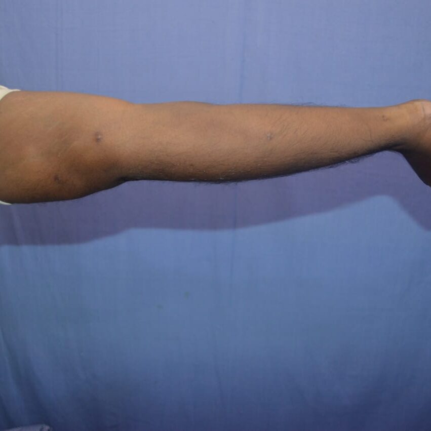 Multiple Lipoma Removal with Minimally Invasive Surgery | Redefine U