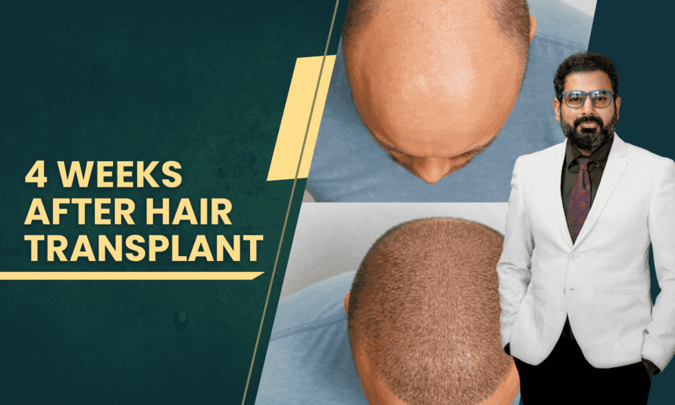 4 Weeks After Hair Transplant | Dr Harikiran Chekuri